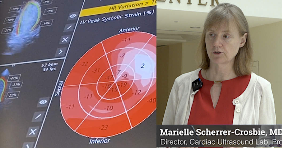 Interest in strain echo imaging is rising, but hurdles remain