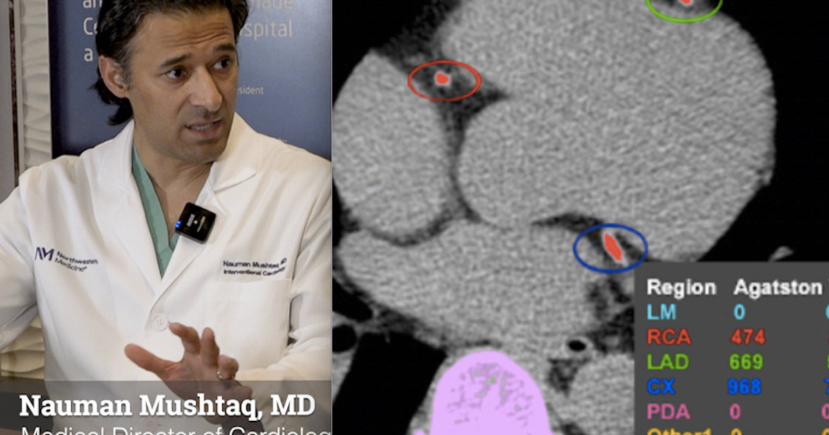 The many benefits of using low-cost CT coronary calcium scoring to ...