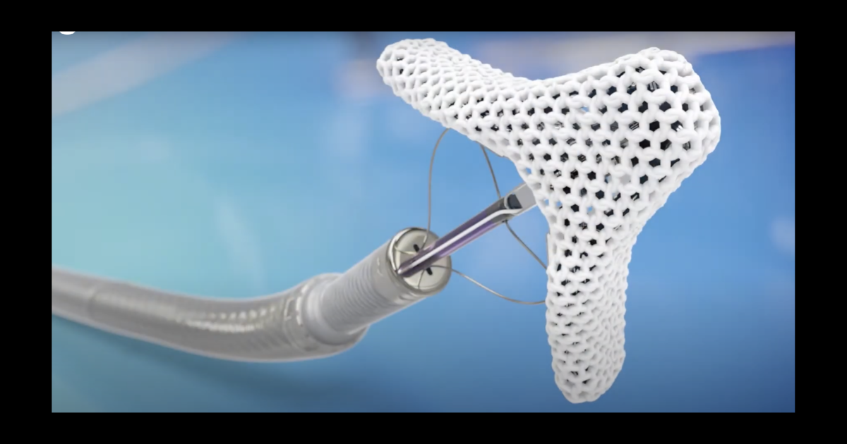 First comprehensive T-TEER resource examines best practices for ...