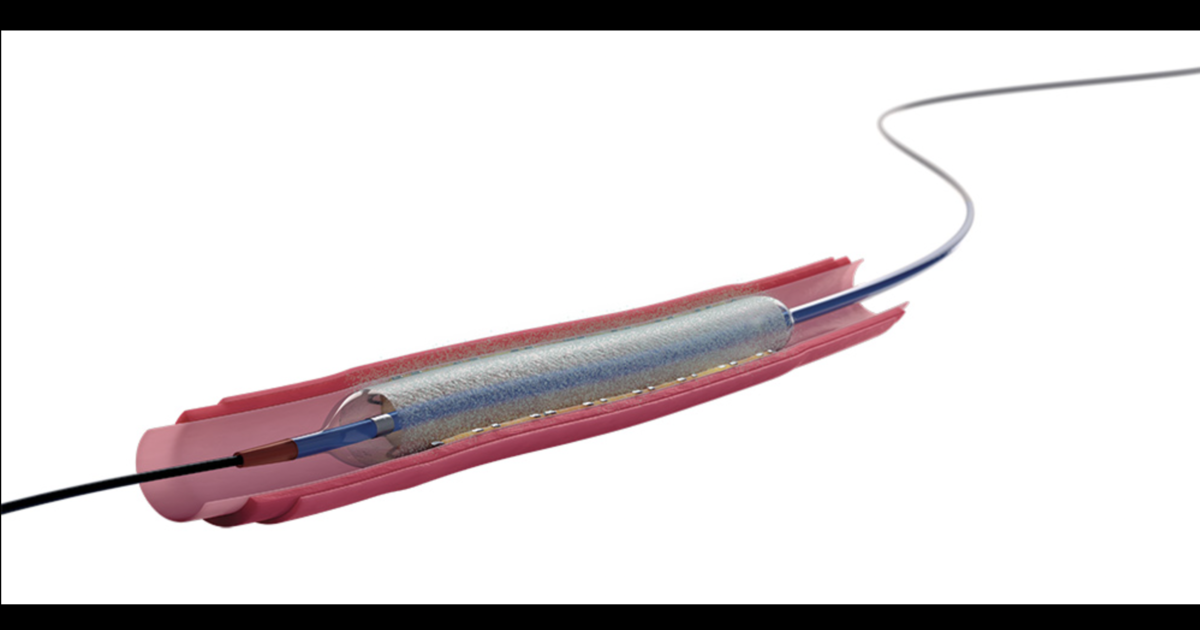 Boston Scientific’s coronary DCB gains new Medicare reimbursement