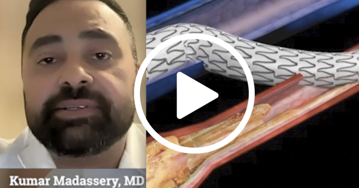 Interventional techniques can help limit amputations among CLI patients