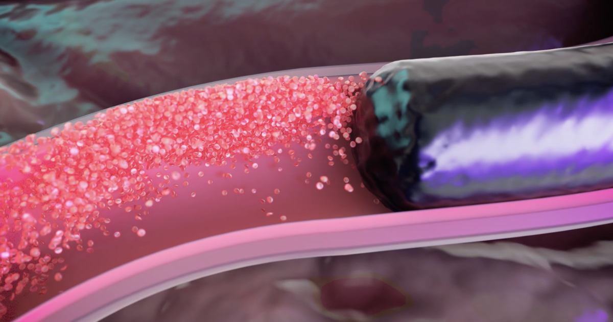 Boston Scientific updates instructions for recalled embolic agent ...