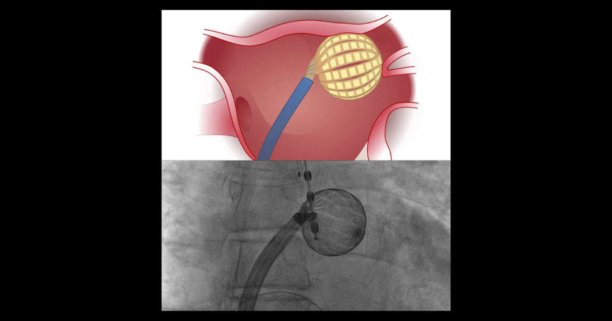 Cardiologist sees ‘tremendous potential’ in new-look PFA system