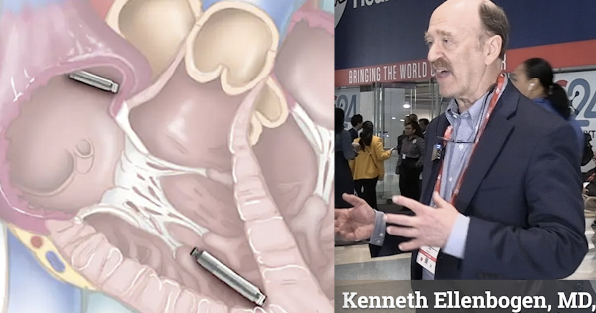 Key trends in electrophysiology include PFA, dual-chamber leadless ...