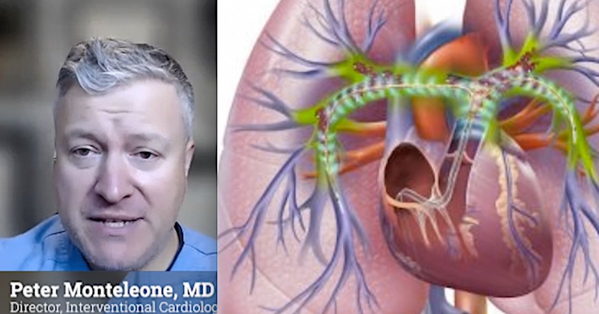 A cardiologist's guide to treating pulmonary embolism