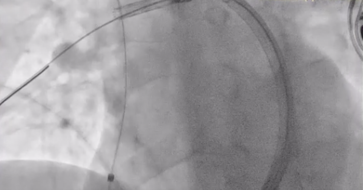 FDA grants new heart failure implant its breakthrough device designation