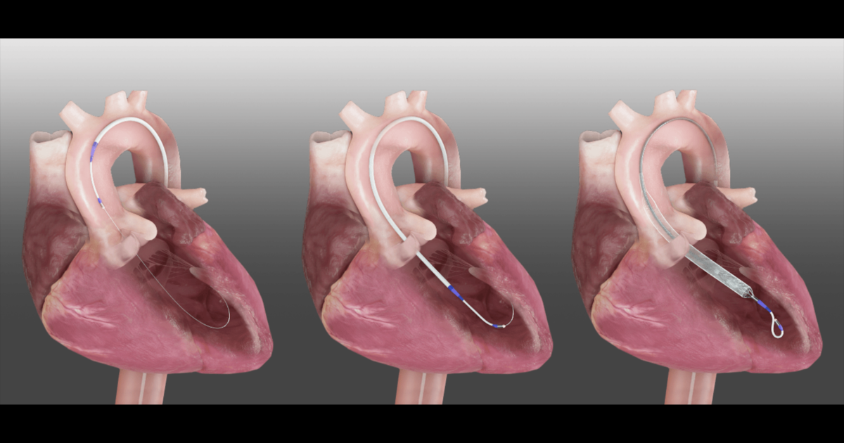 Medical device company raises another $105M for new-look heart pump