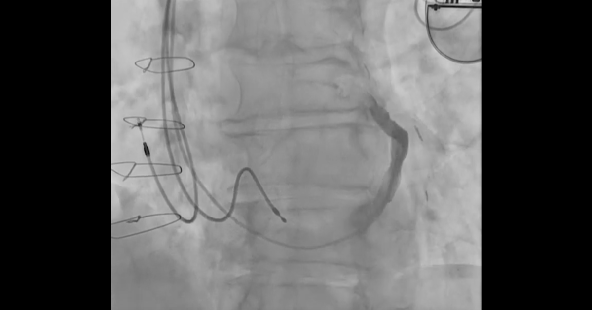 coronary sinus fluoroscopy