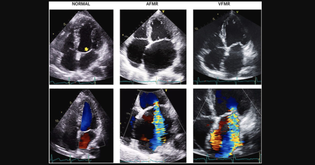 mitral valve prolapse echo