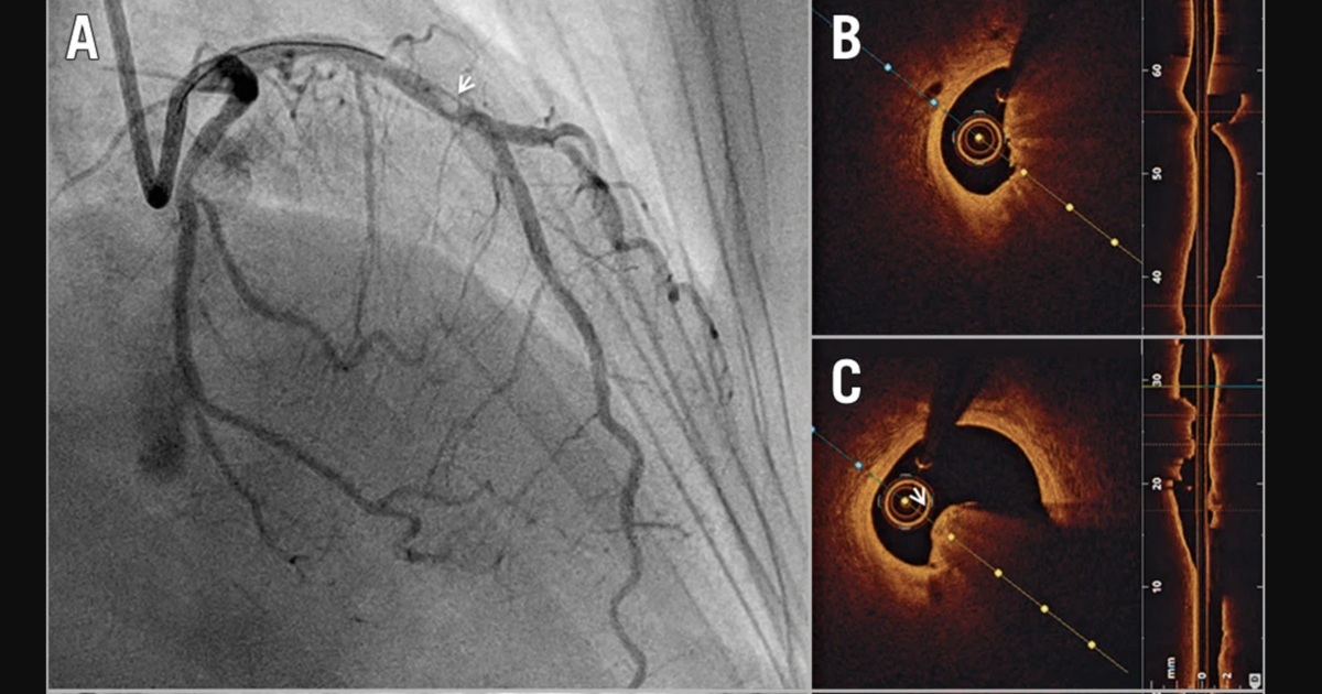 OCT-guided PCI boosts outcomes when treating complex lesions