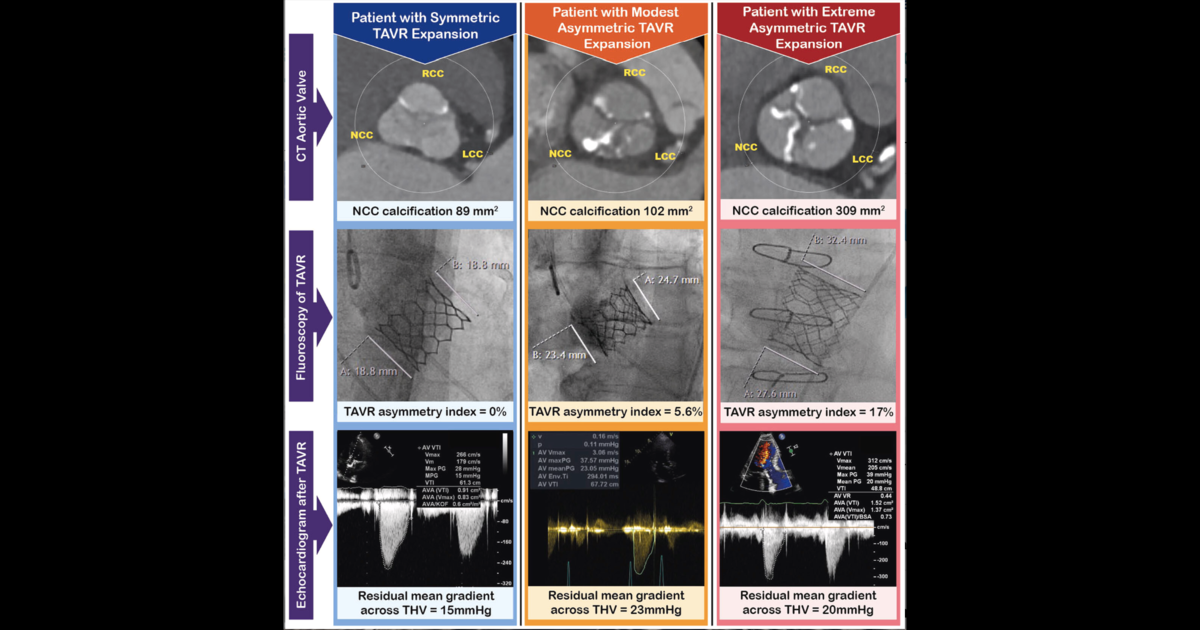 Asymmetrical valve expansion after TAVR a cause for concern