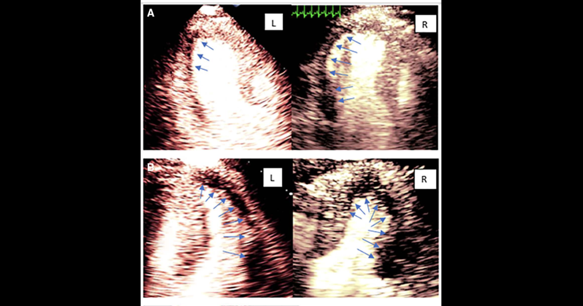 Ultrafast myocardial contrast echocardiography shows early potential to ...