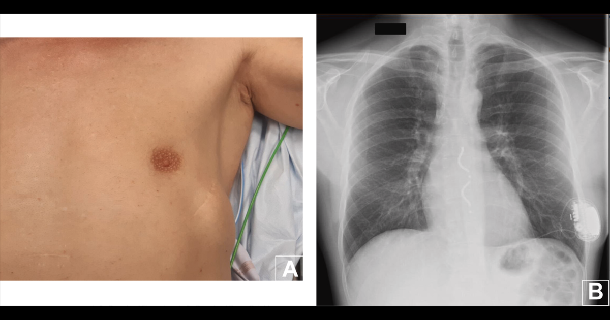 Cardiologists perform world’s first substernal lead extraction