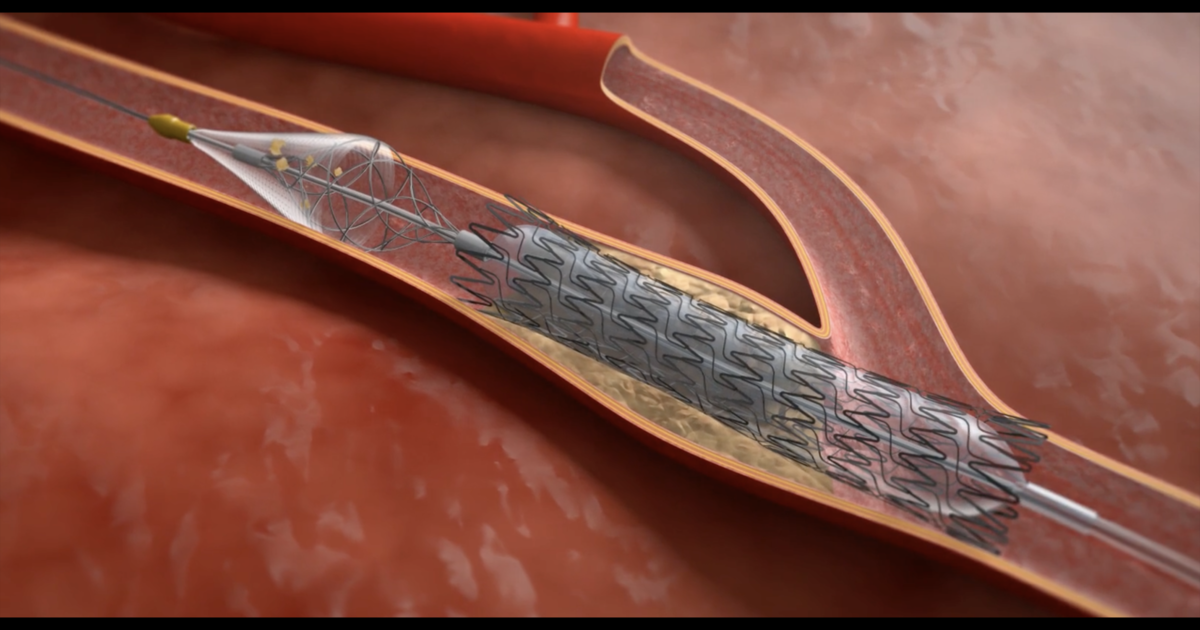 FDA gives green light to 3-in-1 carotid stent system designed to limit ...