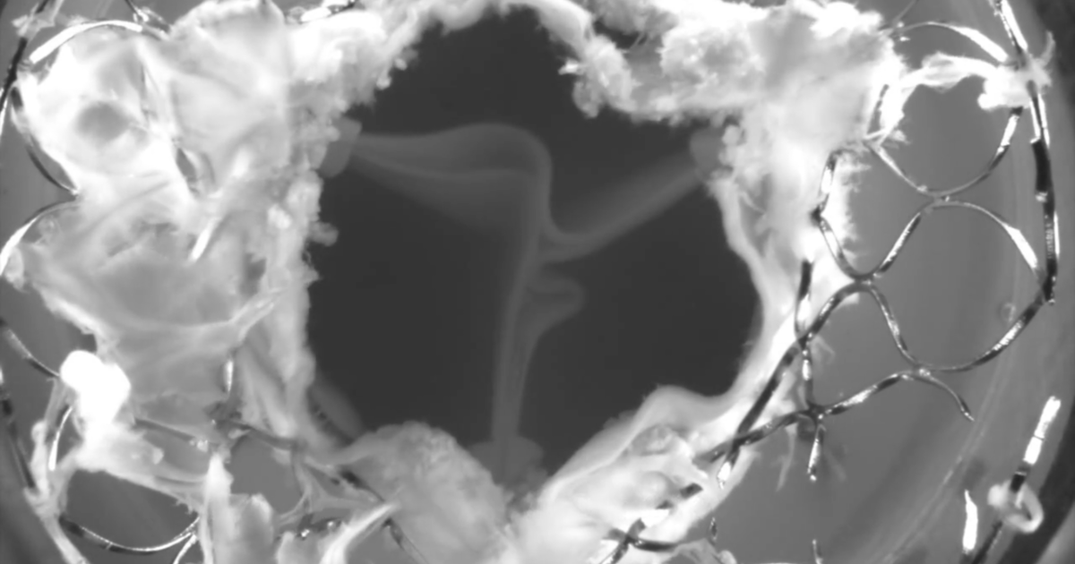 Redo TAVR: The impact of implanting balloon-expandable valves in failed ...