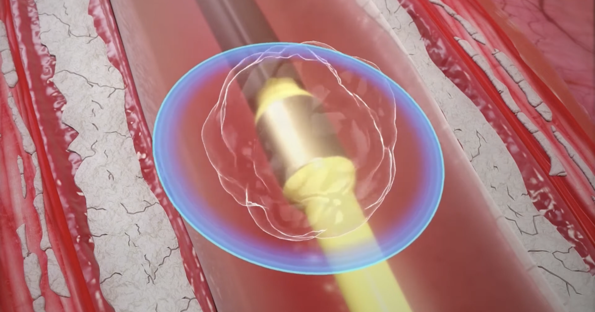 Shockwave Medical’s IVL technology still safe, effective in patients ...