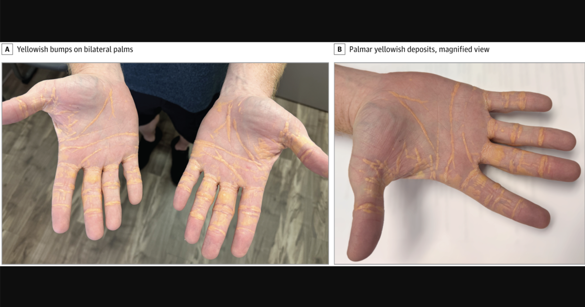 does high cholesterol affect skin