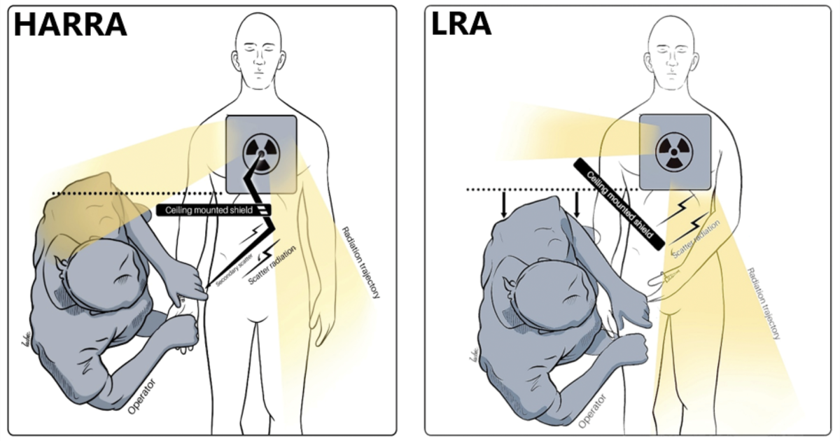 Choosing left radial access in the cath lab helps cardiologists limit ...