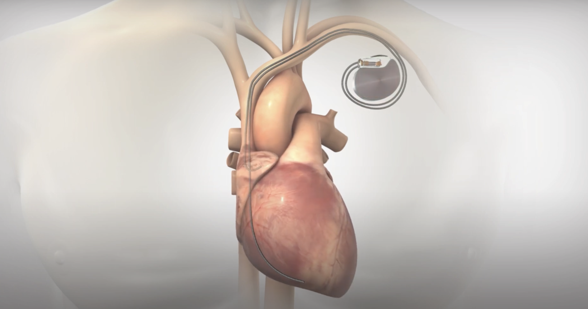 FDA sees potential in new pacemaker-guided hypertension therapy