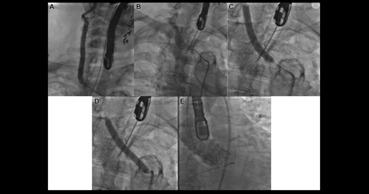 A new use for IVL: helping cardiologists secure transcarotid access for ...