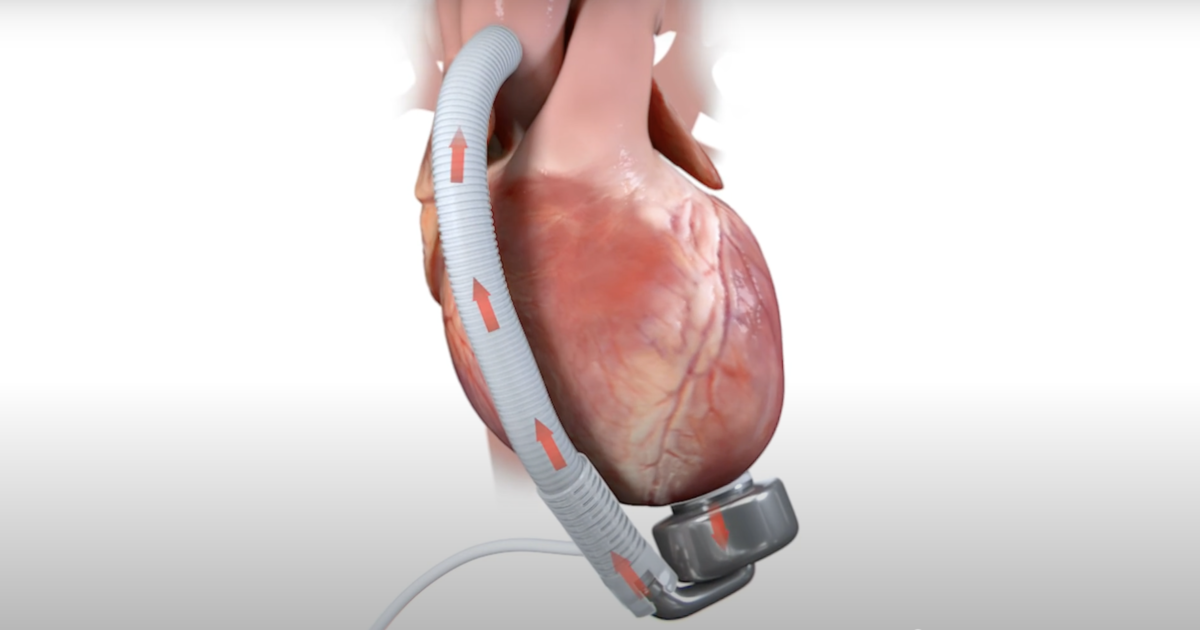 heartware lvad