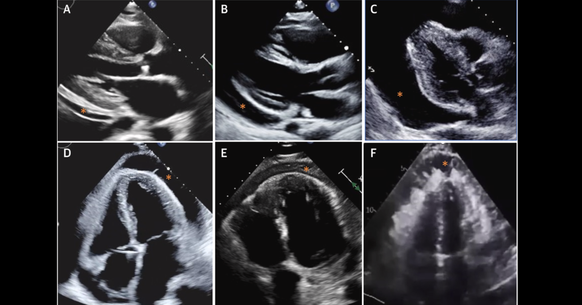 pericarditis angiogram