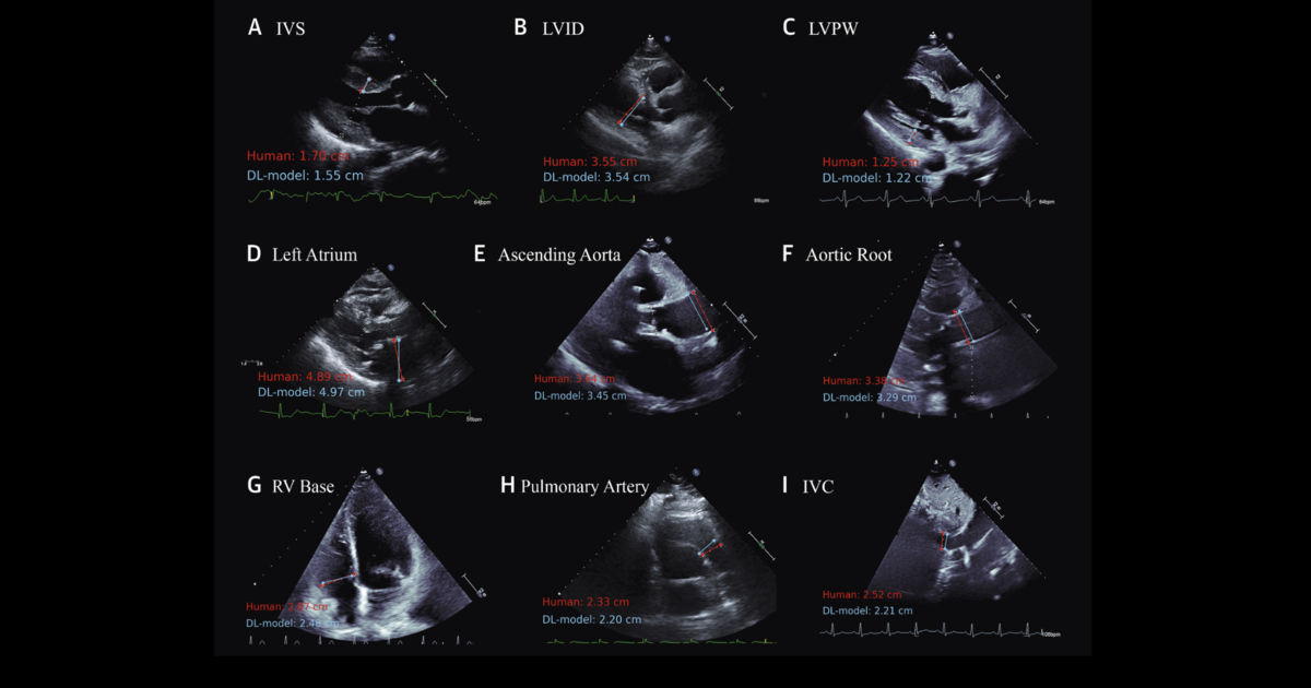 Open-source AI model delivers accurate echocardiography assessments