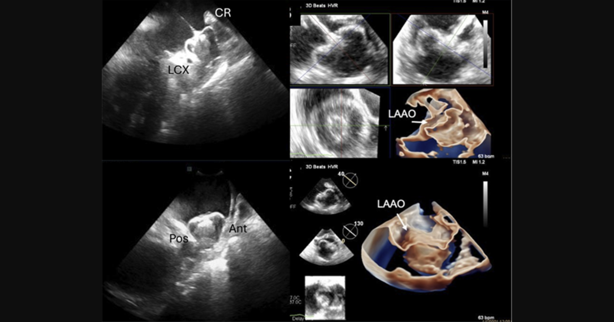 SCAI highlights the benefits of ICE-guided structural heart interventions