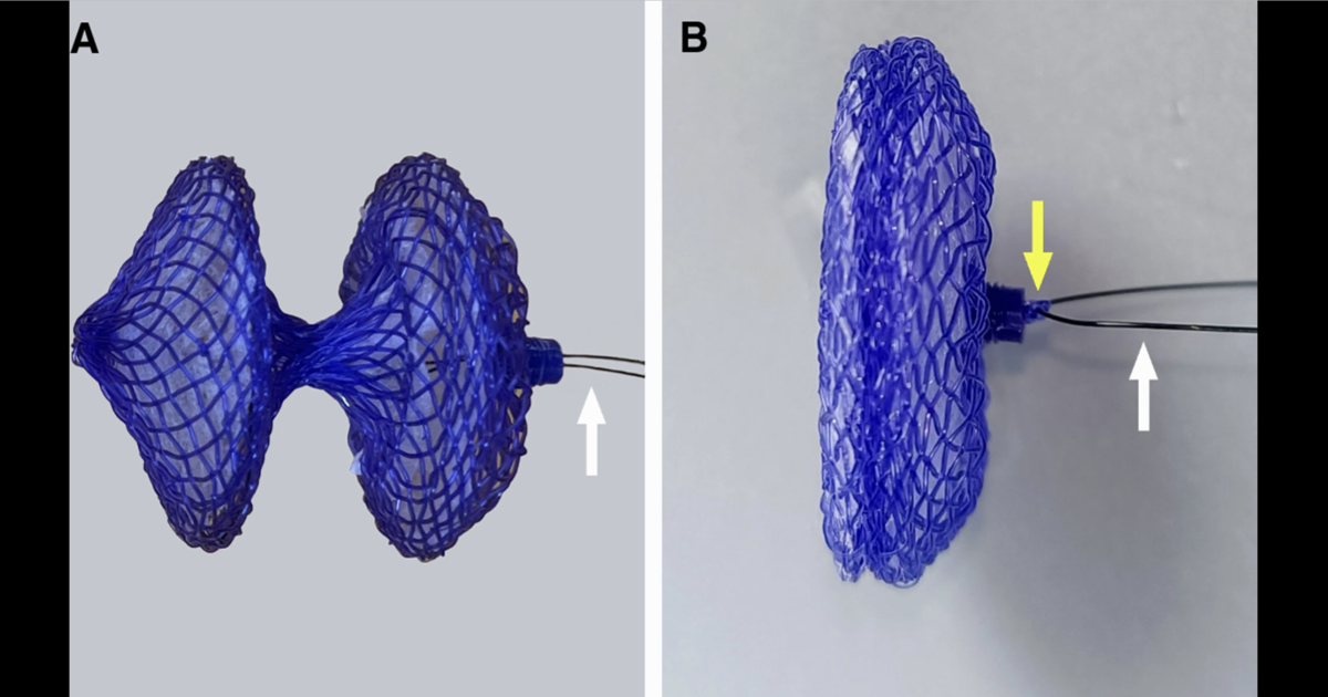 New biodegradable PFO closure device shows early potential