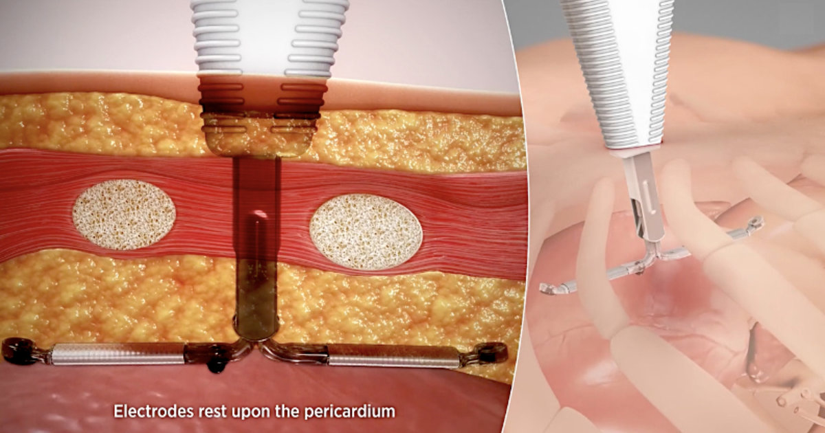 Abbott works with AtaCor Medical on extravascular ICD system