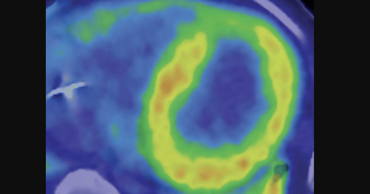 Cardiac amyloidosis in the spotlight at Heart Failure 2026