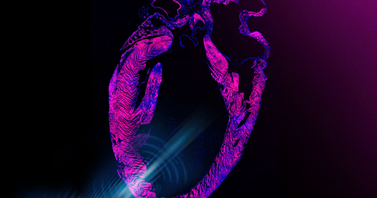 New-look pacemaker uses ultrasound to stimulate the heart—no implant ...