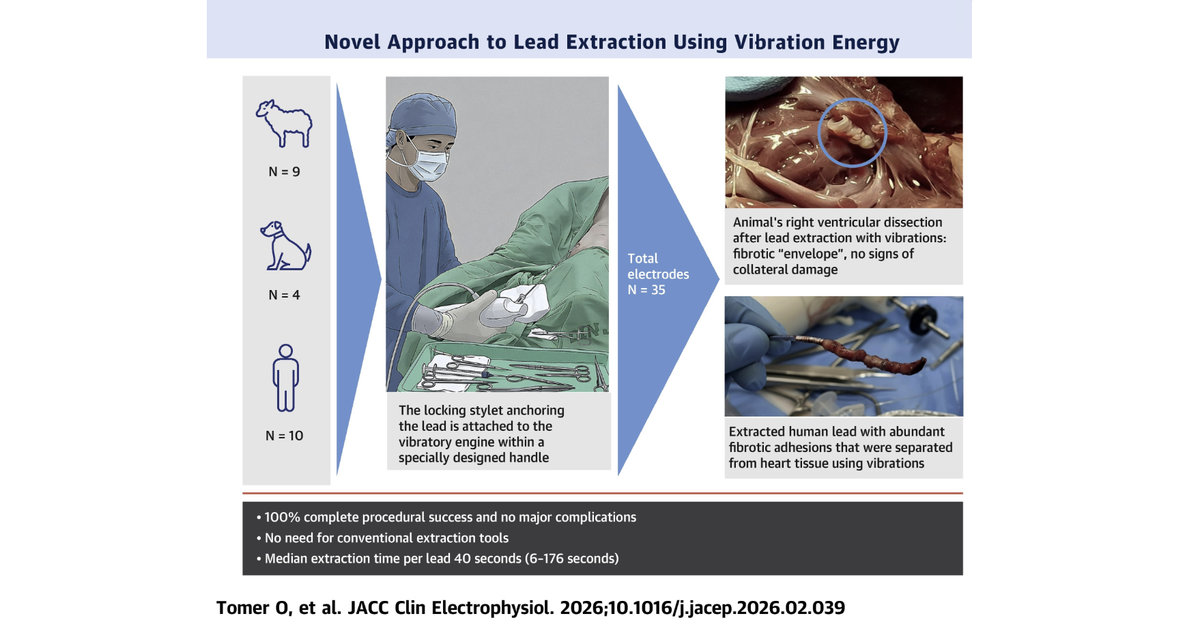 Vibrations used to extract EP leads in first-in-human study