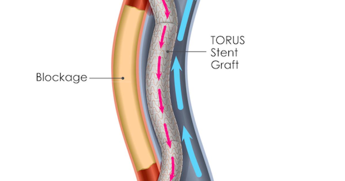 FDA approves trial to test percutaneous procedure for PAD