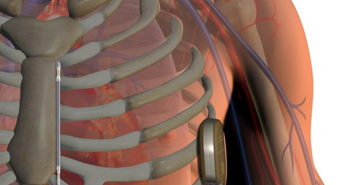 FDA approves 2nd generation subcutaneous ICD