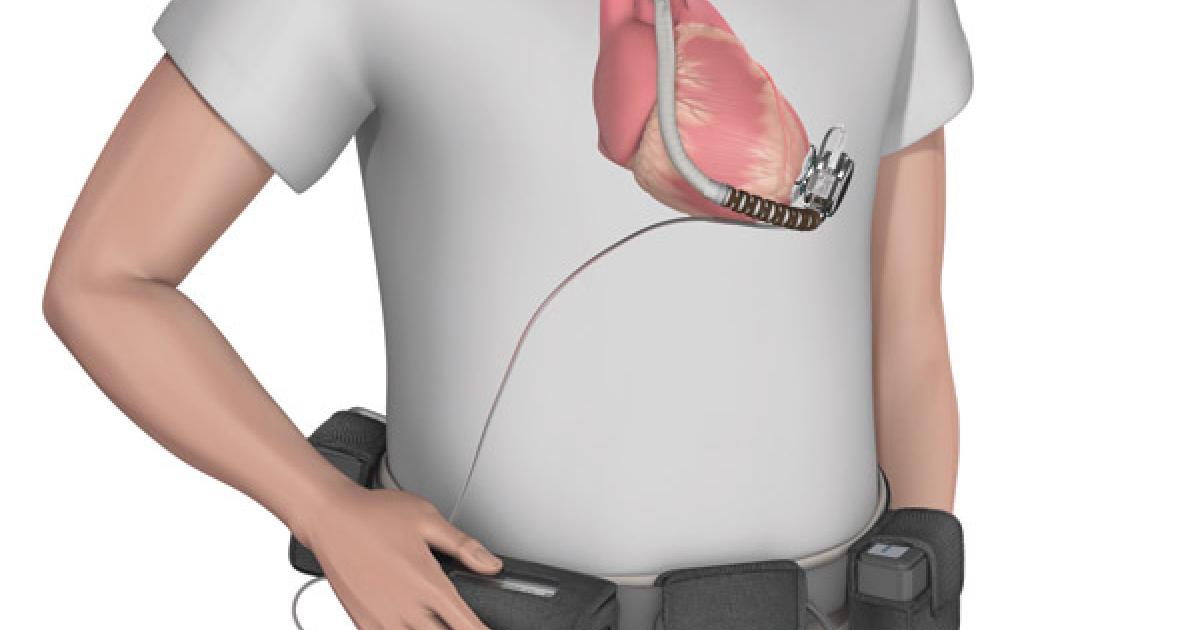 HeartWare: Monitor VAD batteries