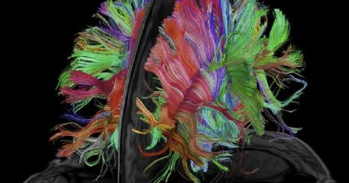 Mind boggling: Brain imaging reveals MI, stroke risks