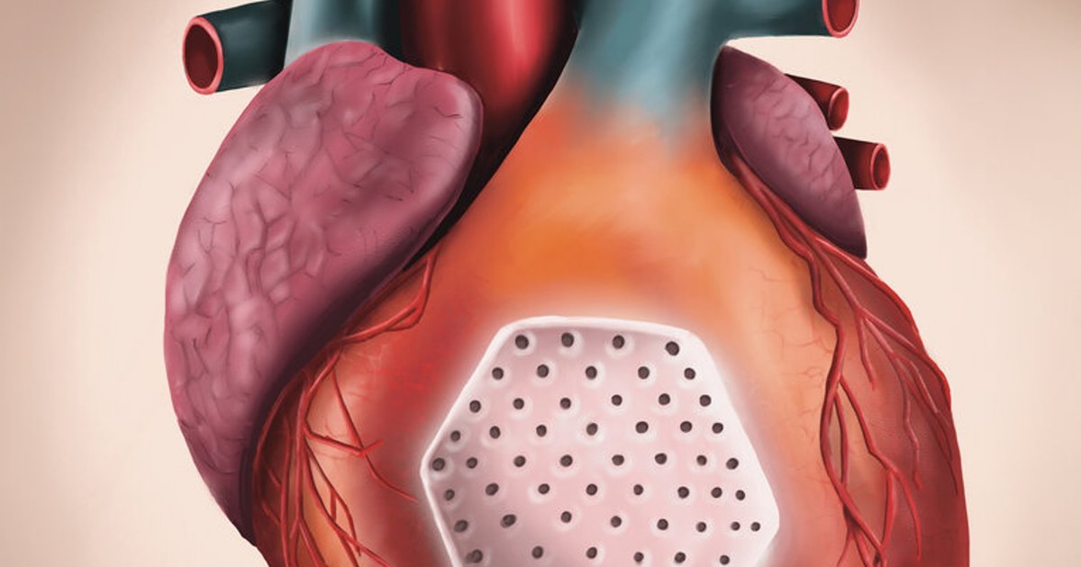 Repairon announces positive clinical outcomes of engineered heart ...