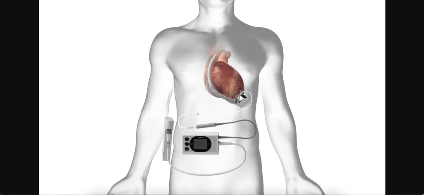 Surgeons make history with first US implant of new magnetically ...