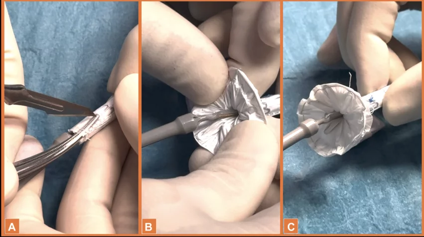 elephant trunk procedure