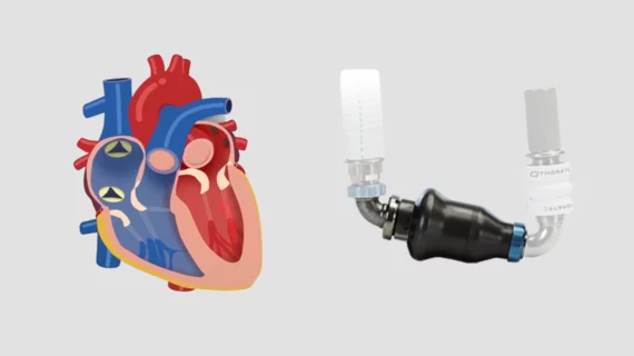 Cardiologists shed new light on treating severe tricuspid regurgitation ...