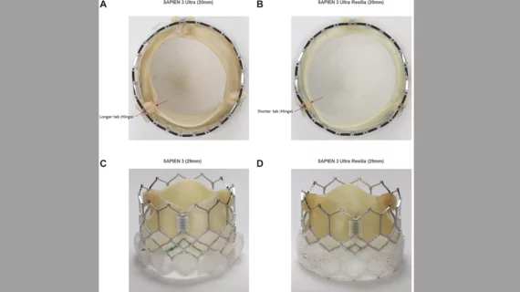 Updated balloon-expandable TAVR valve from Edwards outperforming its ...