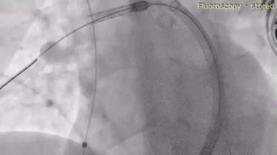 FDA grants new heart failure implant its breakthrough device designation
