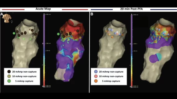 Pfa Ablation Safe Effective For Treating Premature Ventricular