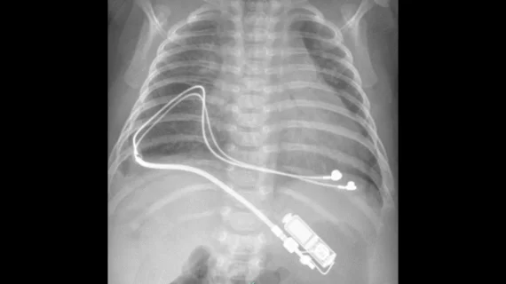 ‘A new alternative’: Tiny pacemakers for infants show early promise