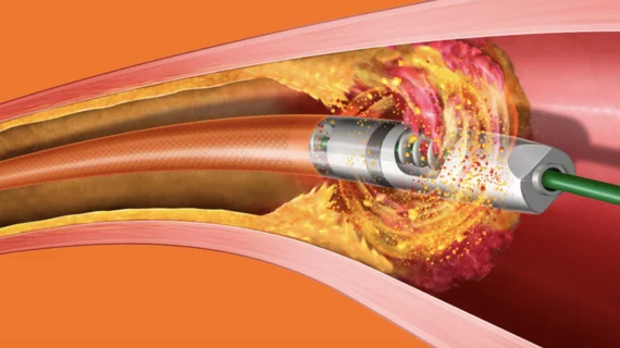 Safety update: FDA announces Class I recall due to atherectomy devices ...