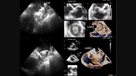 SCAI highlights the benefits of ICE-guided structural heart interventions