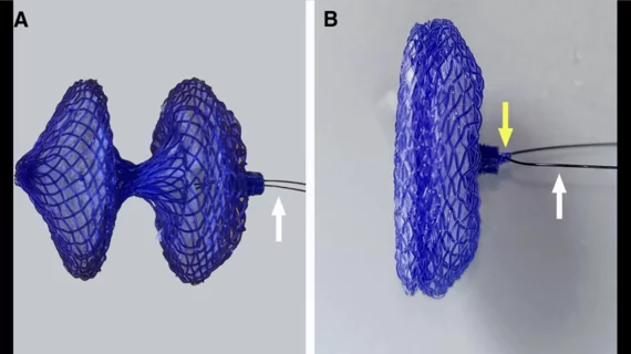 New biodegradable PFO closure device shows early potential