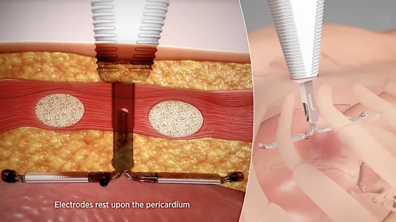 Abbott works with AtaCor Medical on extravascular ICD system