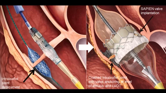 Cardiologists perform first TAVR of its kind by anchoring valve to ...